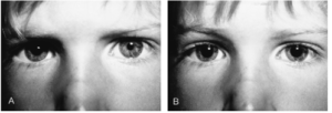 Neuro-ophthalmology Question of the Week: Physiologic Anisocoria ...