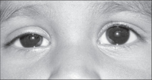 Neuro-ophthalmology Question of the Week: Horner Syndrome in Children ...
