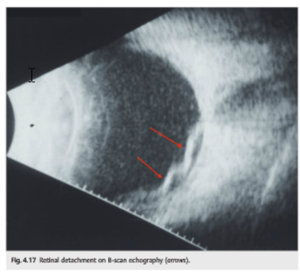 Neuro-ophthalmology Question of the Week: B-scan Ultrasound — Neuro ...